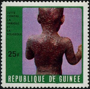 Stamp: Child with Smallpox (Guinea(Fight against smallpox and measles ...