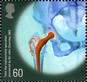 Stamp: Total Hip Replacement (United Kingdom of Great Britain ...